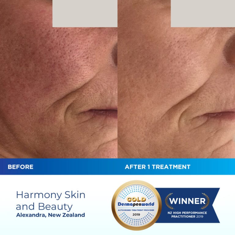 Reducing Pigmentation and Sun Damage with Dermapen Microneedling