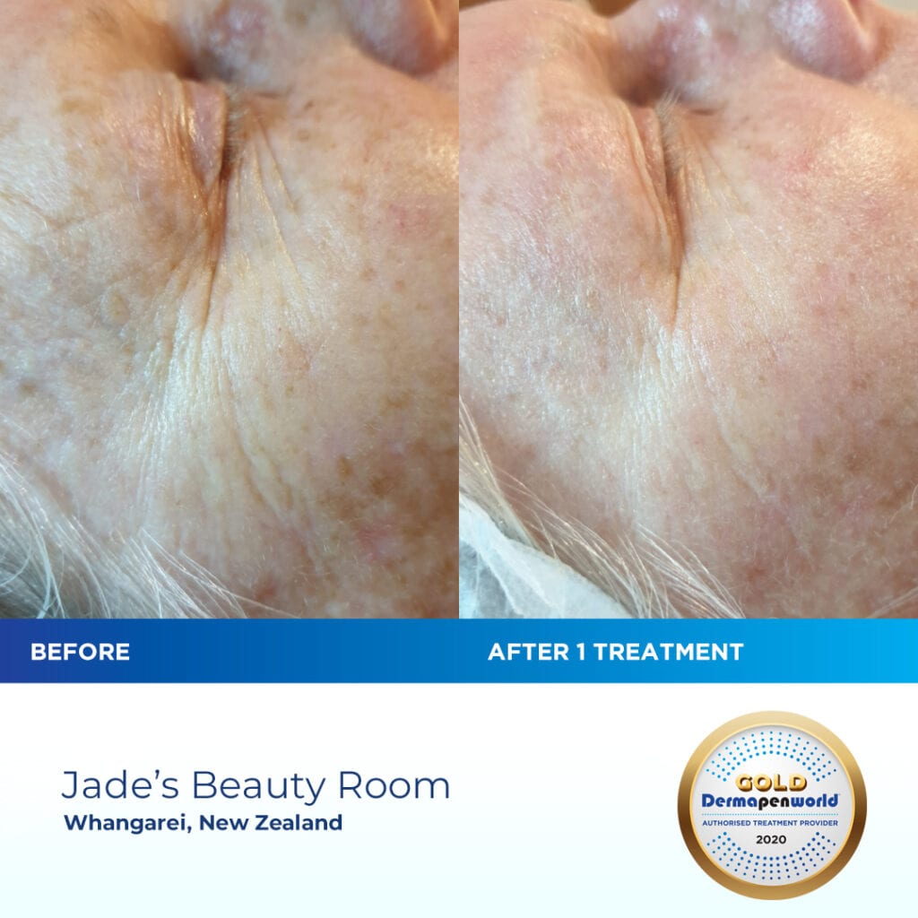 Reducing Pigmentation and Sun Damage with Dermapen Microneedling