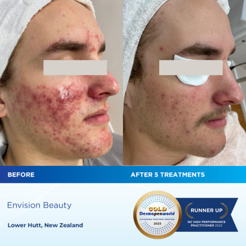 Dermapen Microneedling - Collagen Induction Therapy - PROBEAUTY