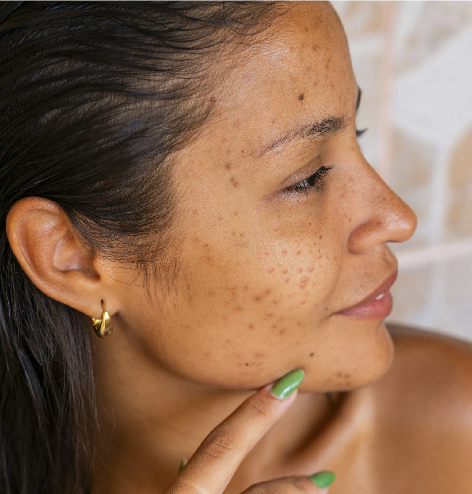 Acne & Breakouts